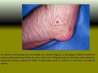 Melhores práticas artrocentese | PPTX