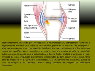 Melhores práticas artrocentese | PPTX