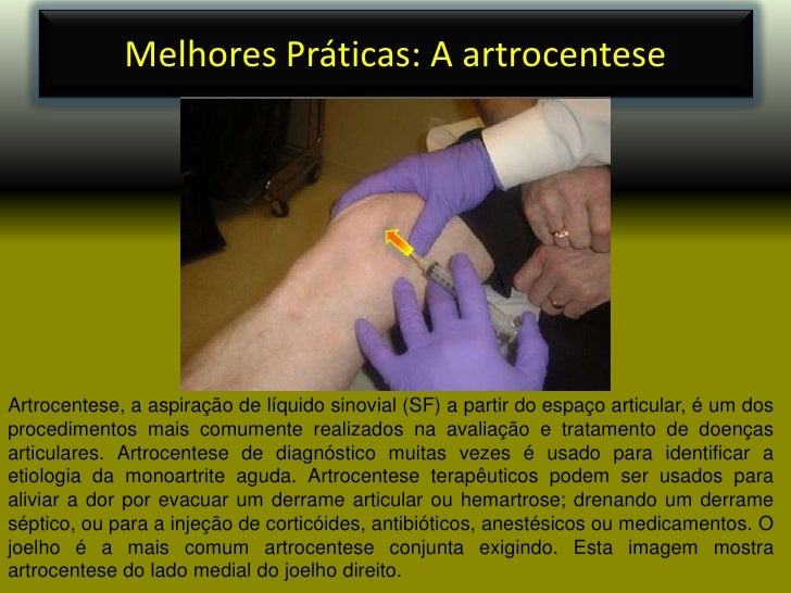Melhores práticas artrocentese