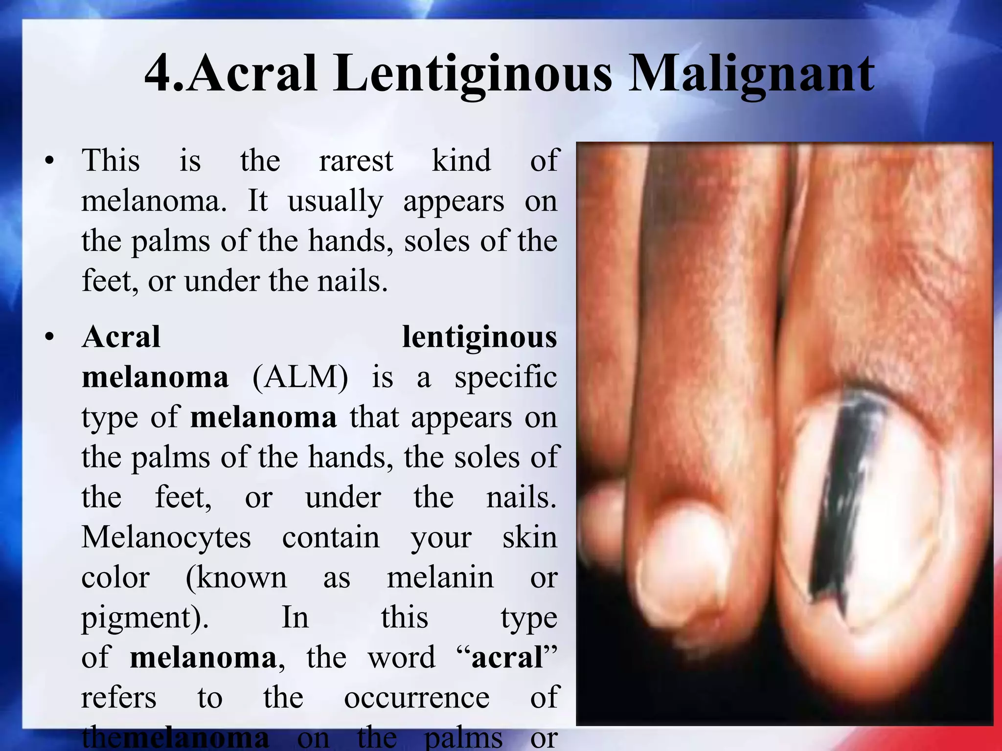 Malignant melanoma Presented by Mo. Haroon Rashid | PPTX