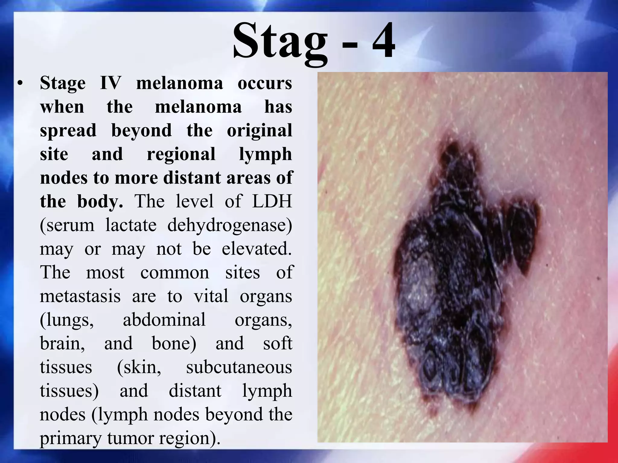 Malignant Melanoma Presented By Mo Haroon Rashid Pptx