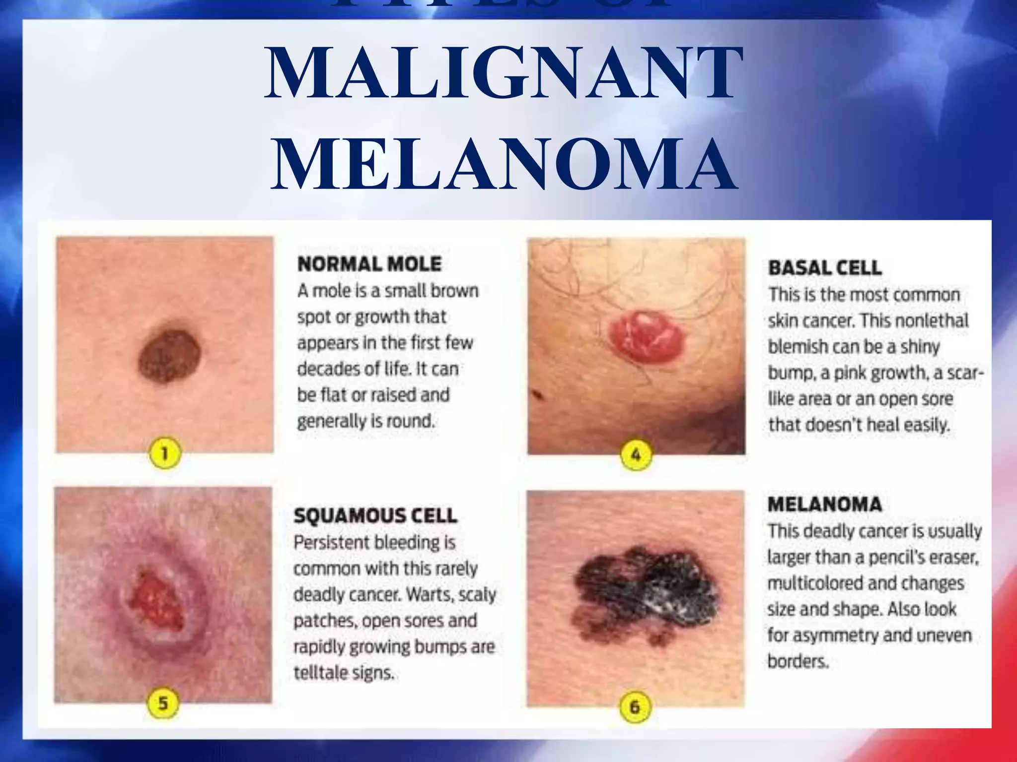 Malignant melanoma Presented by Mo. Haroon Rashid | PPTX