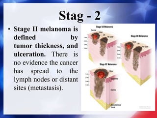 Stage 2 Melanoma