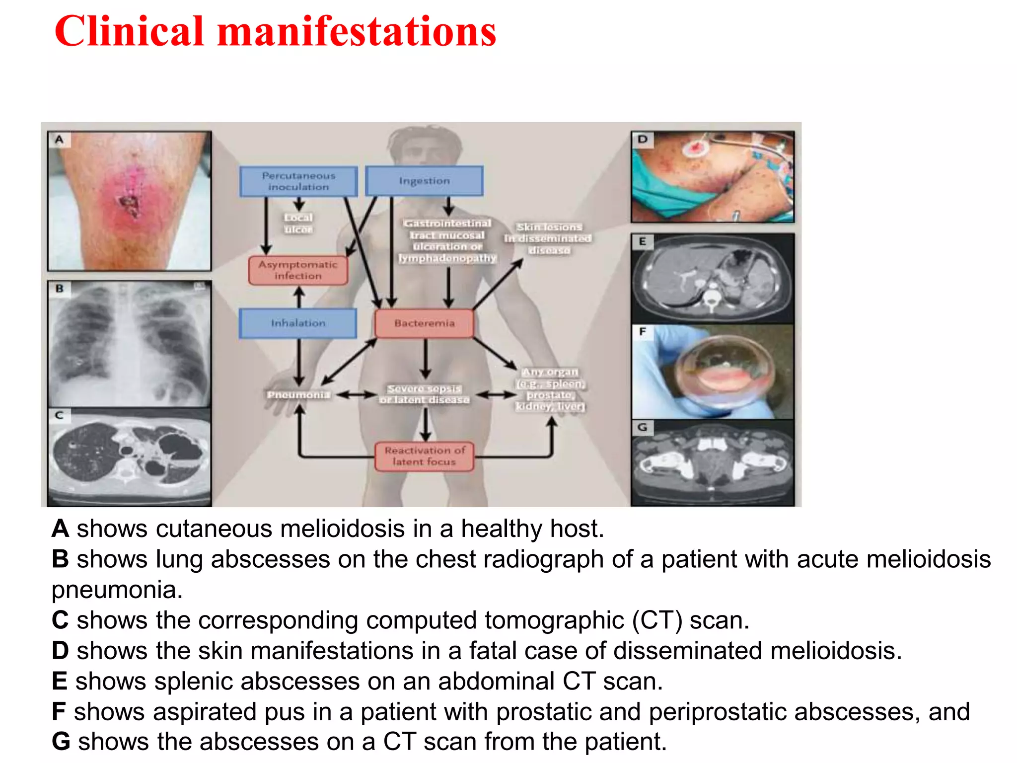 Melioidosis | PPTX
