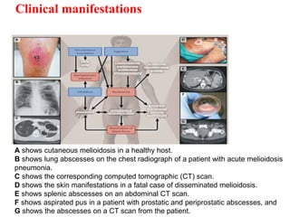Melioidosis | PPTX