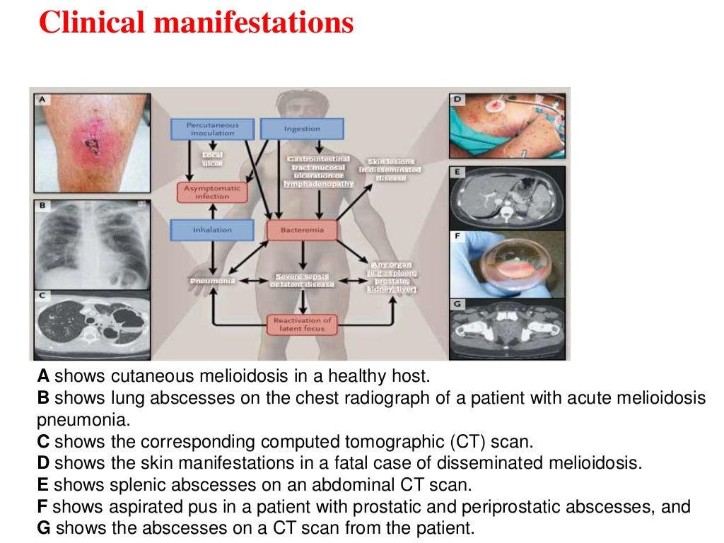 Melioidosis