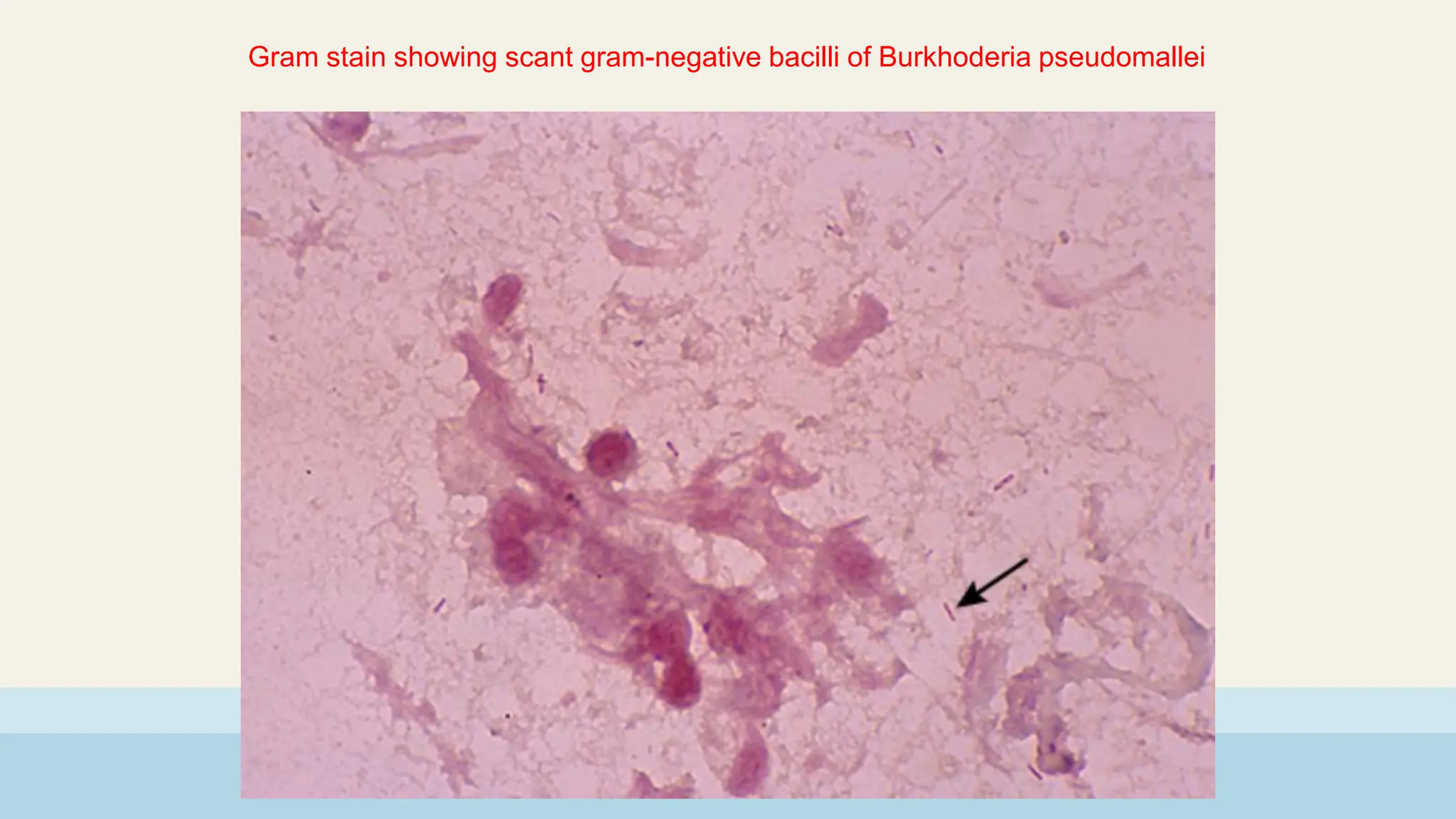 Melioidosis.pptx , Burkholderia pseudomallei | PPTX