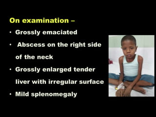 Melioidosis manifesting as liver abscess in a patient | PPTX