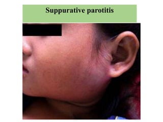 Melioidosis Topic.pptx