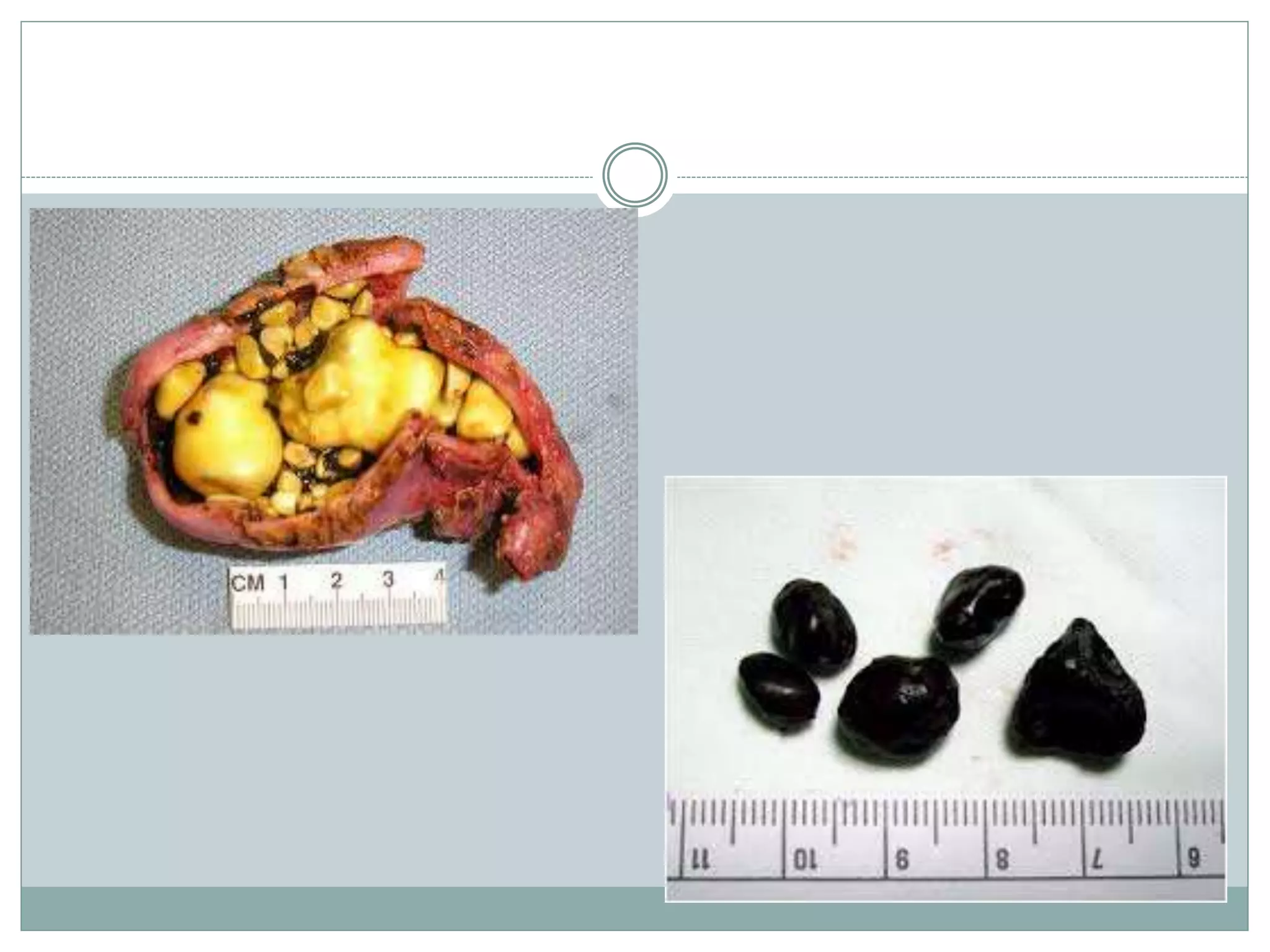 MELLSS yr2 pathology gall stones | PPT