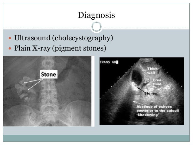 MELLSS yr2 pathology gall stones
