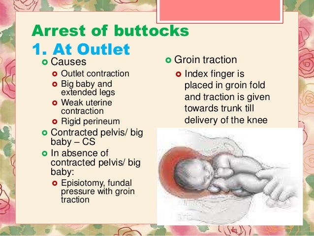 Mellss obg y3 breech