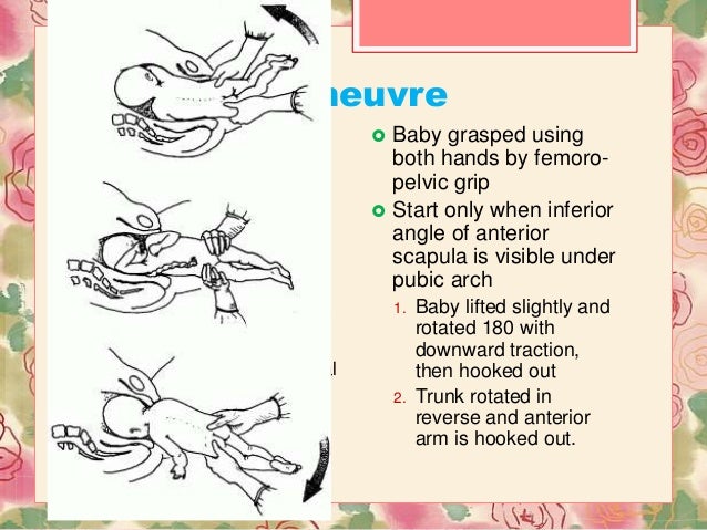 Mellss obg y3 breech