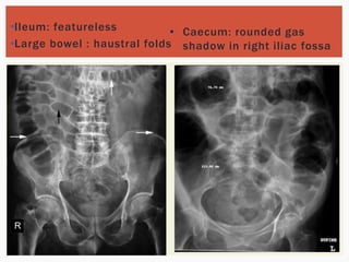 Mellss surgery y3 intestinal obstruction | PPTX