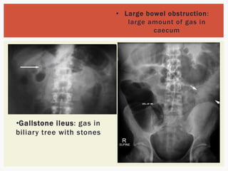 Mellss surgery y3 intestinal obstruction | PPTX