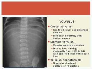 Mellss surgery y3 intestinal obstruction | PPTX