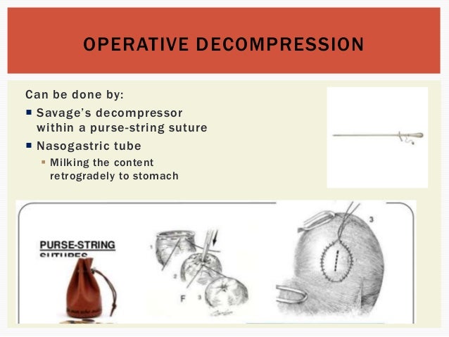 Mellss surgery y3 intestinal obstruction