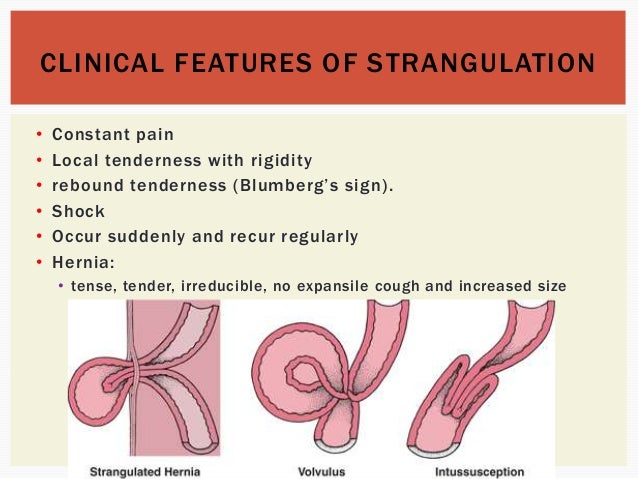 Mellss surgery y3 intestinal obstruction
