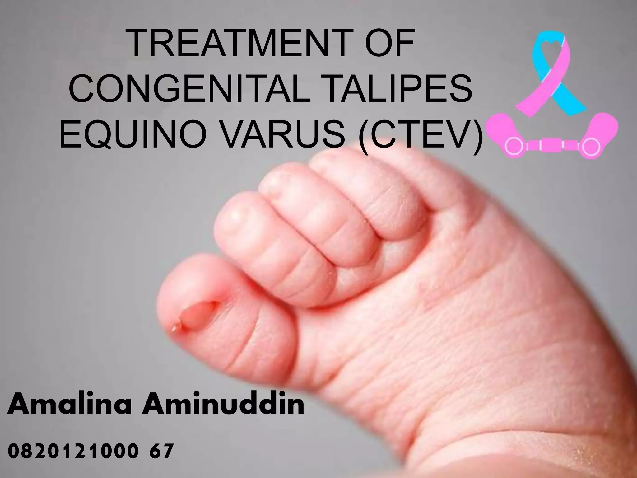 Mellss yr5 ortho treatment of congenital talipes equino varus (ctev) | PPTX