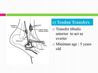 Mellss yr5 ortho treatment of congenital talipes equino varus (ctev) | PPT