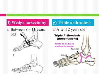 Mellss yr5 ortho treatment of congenital talipes equino varus (ctev) | PPT