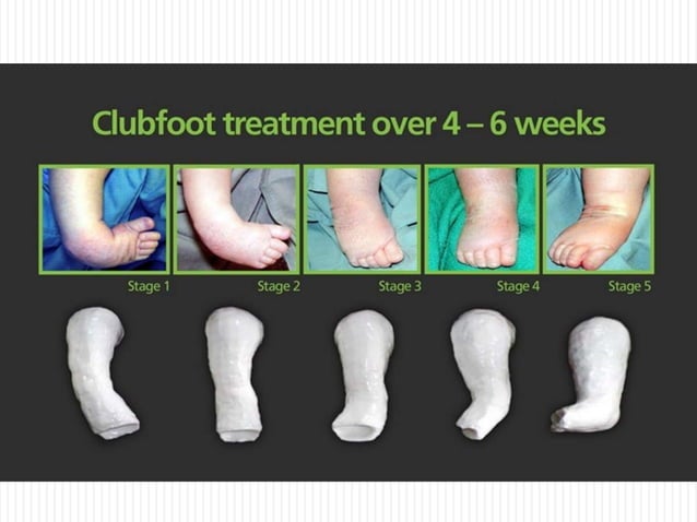 Mellss yr5 ortho treatment of congenital talipes equino varus (ctev) | PPT