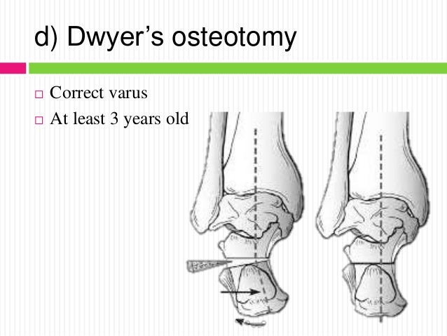 Mellss yr5 ortho treatment of congenital talipes equino varus (ctev)