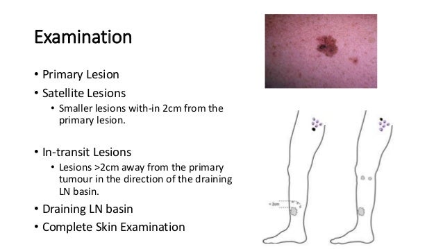 Management of malignant melanoma