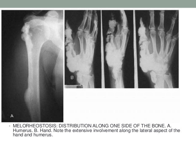 Melorheostosis