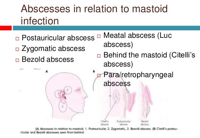 Melss yr4 ent complication of cs om