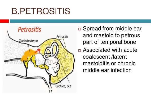 Melss yr4 ent complication of cs om