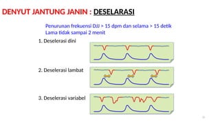 Membaca CTG normal untuk kesejahteraan janin - PIT IDI.pptx