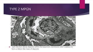 Membranoproliferative glomerulonephritis & c3 glomerulopathy | PPTX