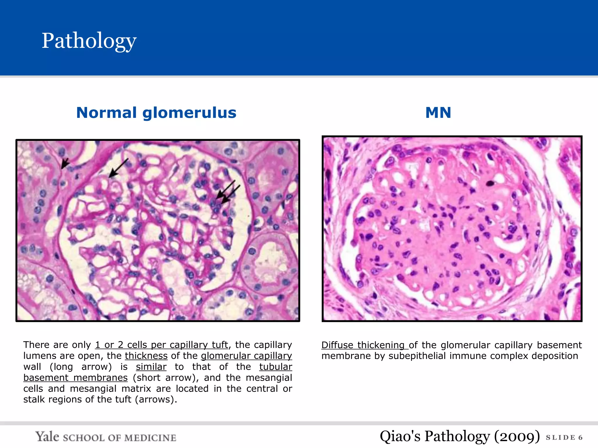 Membranous.pptx