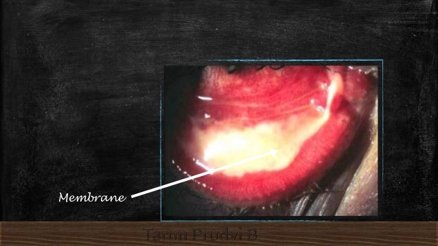 Membranous conjunctivitis
