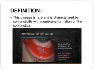 Membranous conjunctivits | PPTX
