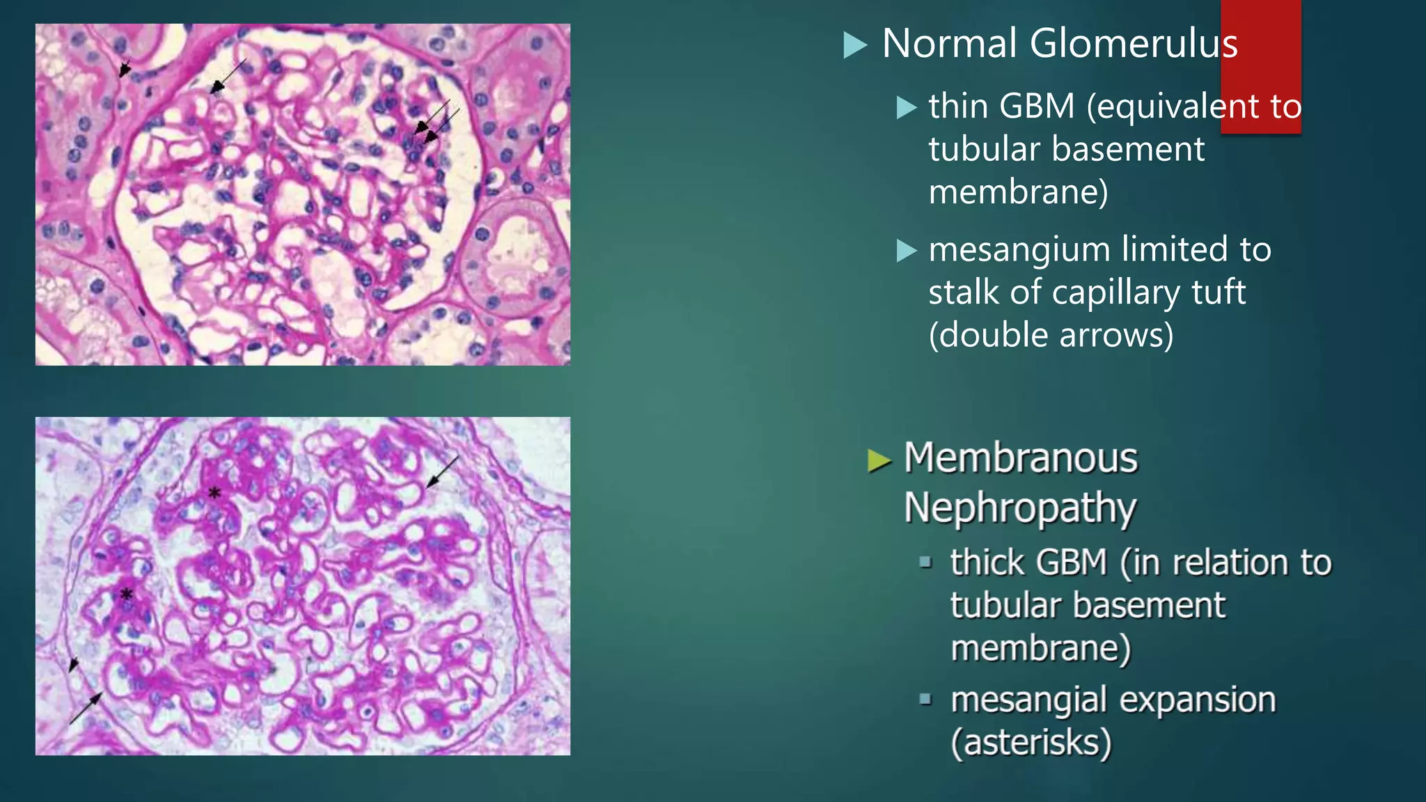 Membranous Glomerulonephritis Pptx