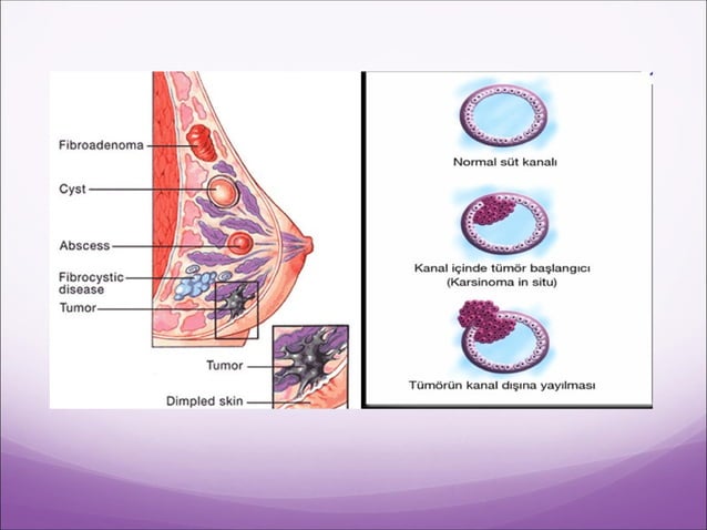 Meme kanseri sunu | PPT