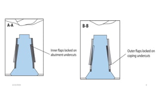 JOURNAL CLUB shape memory abutment.pptx