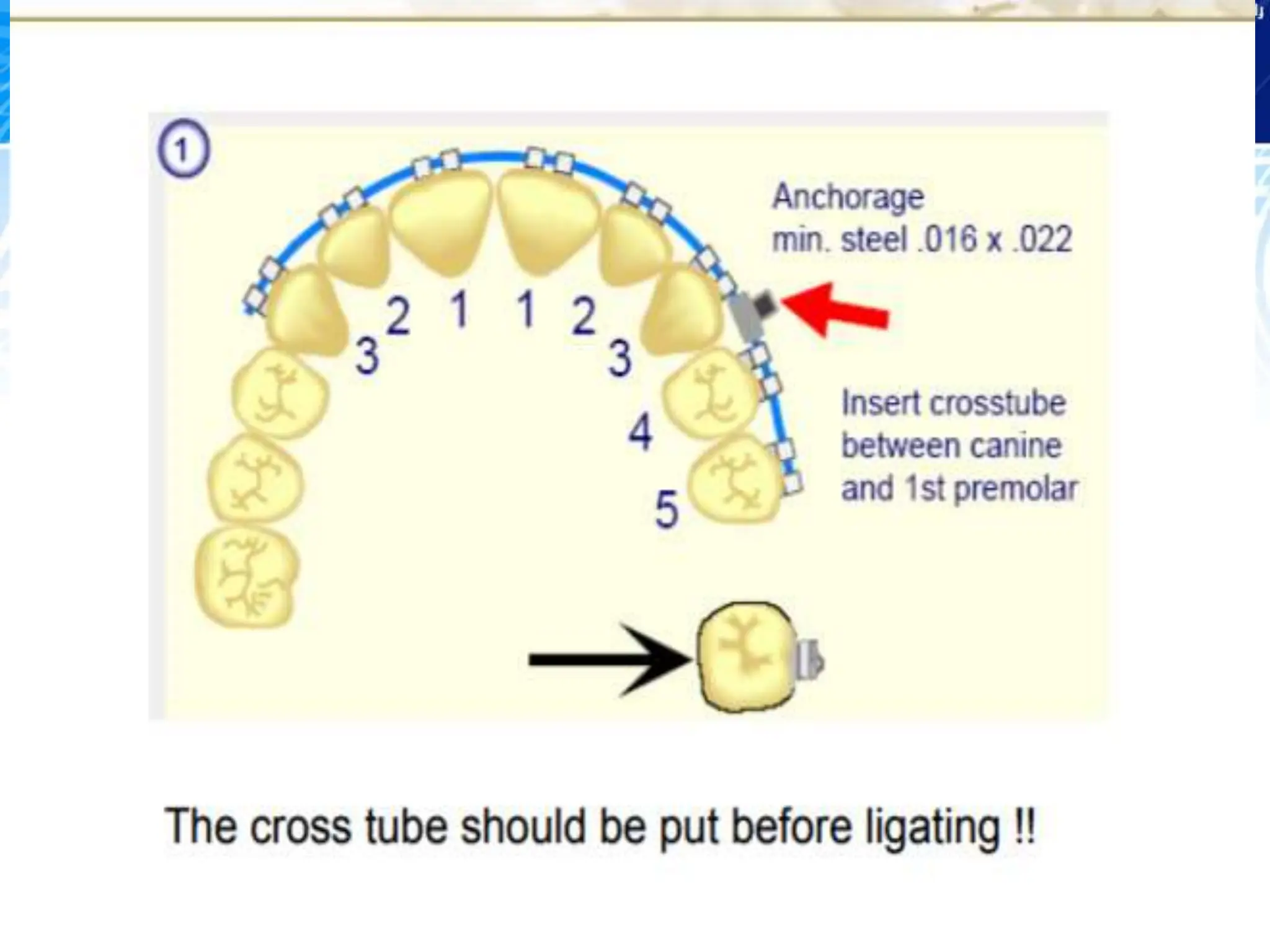 Memory Titanol Spring for Uprighting of Molar.pptx