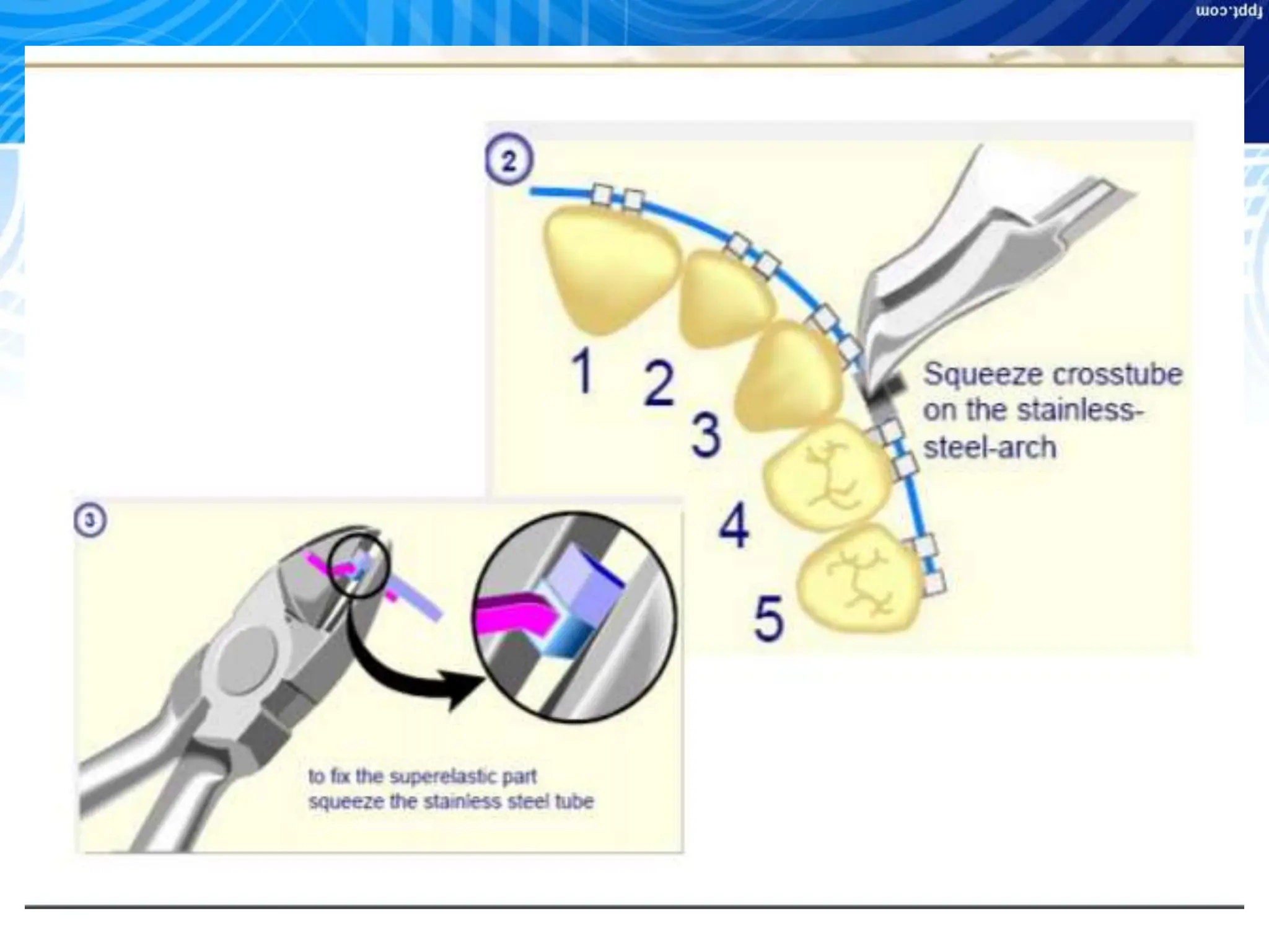 Memory Titanol Spring for Uprighting of Molar.pptx