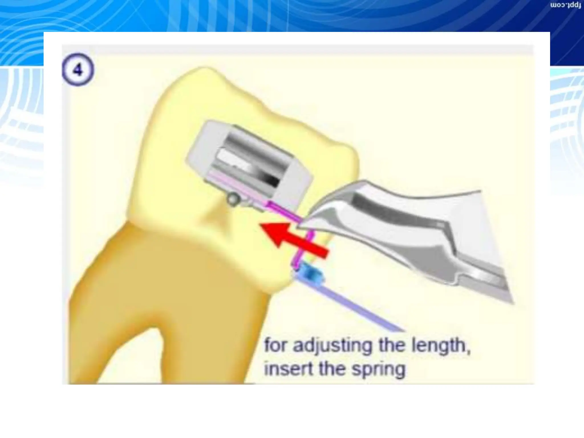 Memory Titanol Spring for Uprighting of Molar.pptx