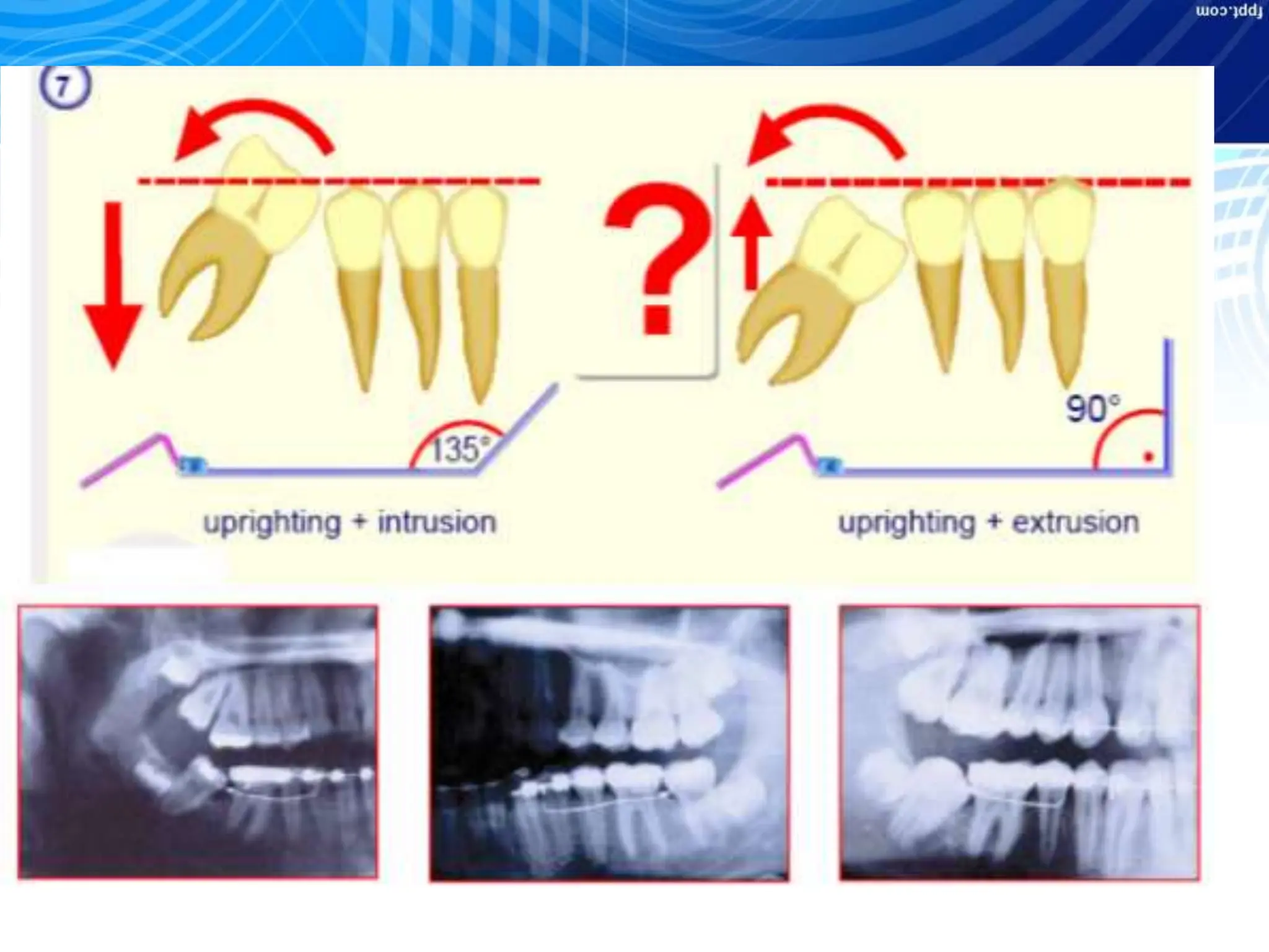 Memory Titanol Spring for Uprighting of Molar.pptx