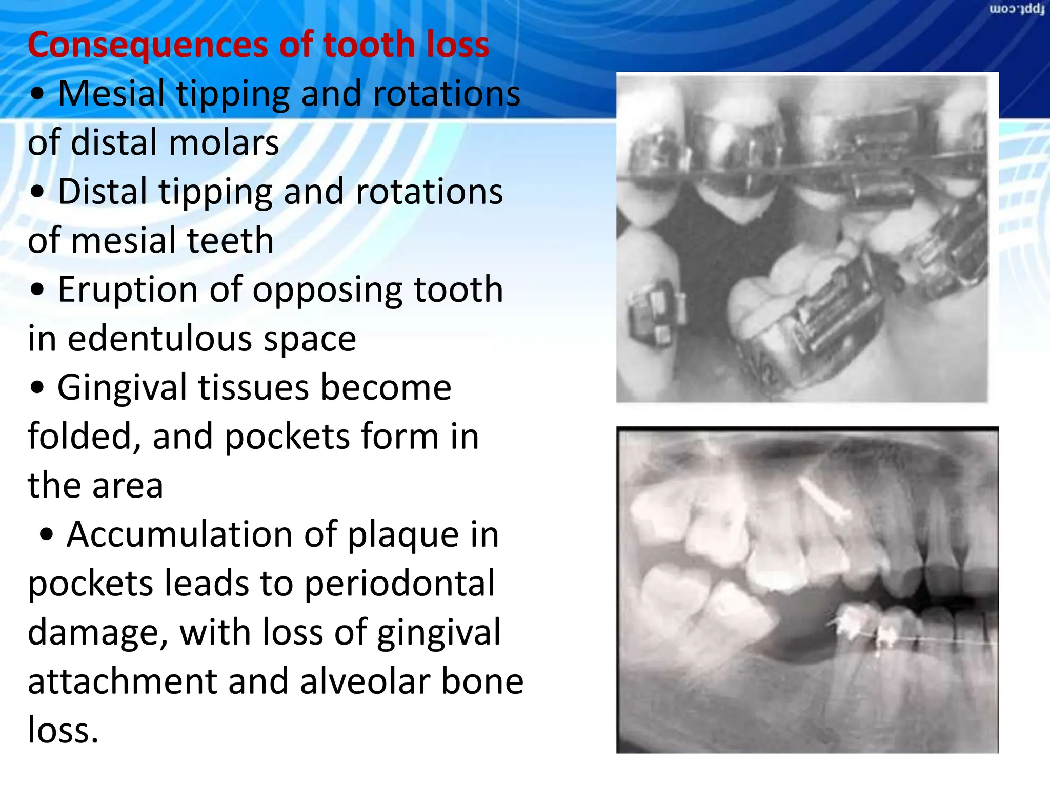 Memory Titanol Spring for Uprighting of Molar.pptx