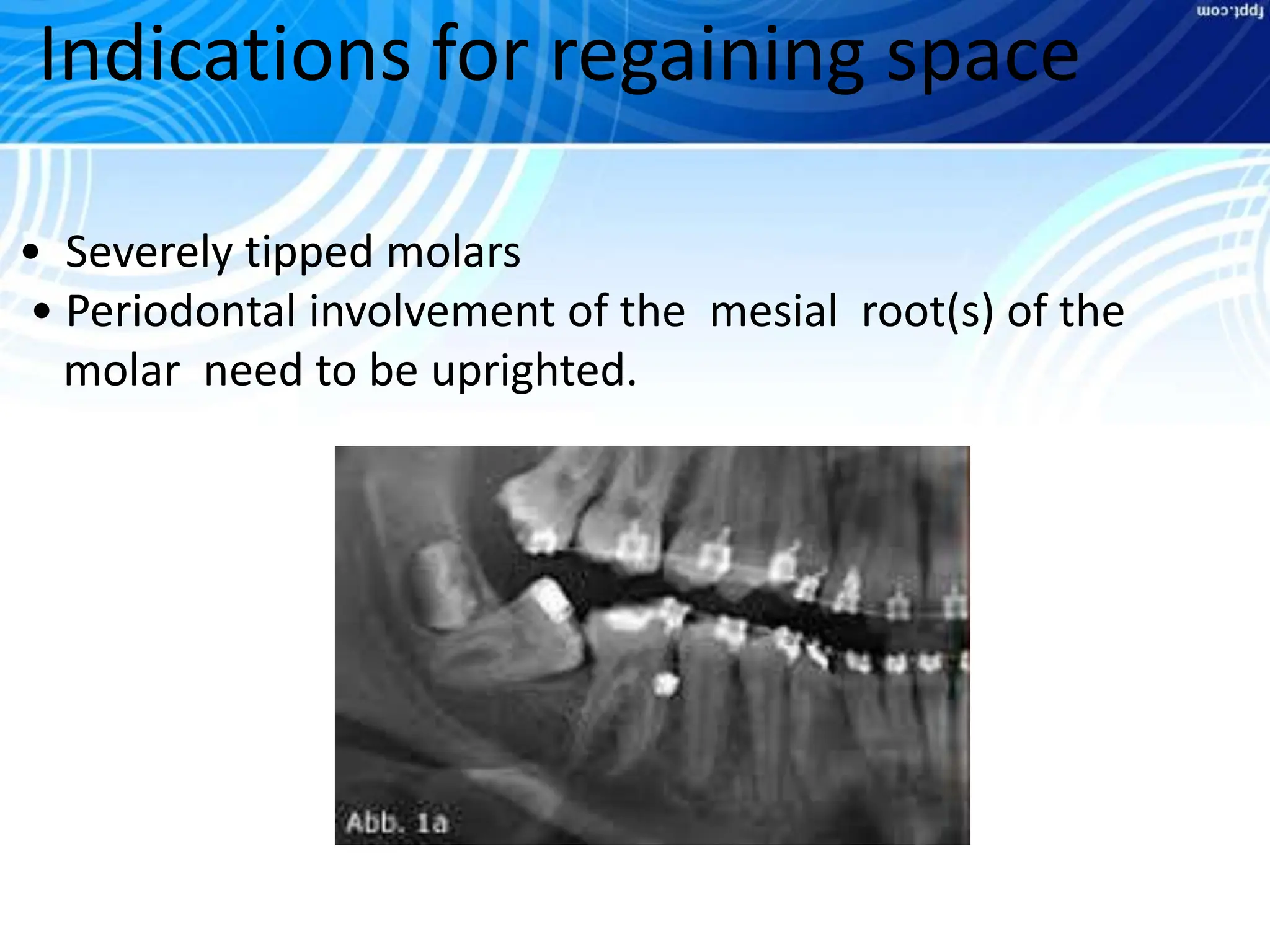 Memory Titanol Spring for Uprighting of Molar.pptx