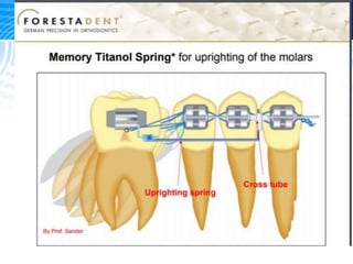 Memory Titanol Spring for Uprighting of Molar.pptx