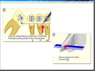 Memory Titanol Spring for Uprighting of Molar.pptx