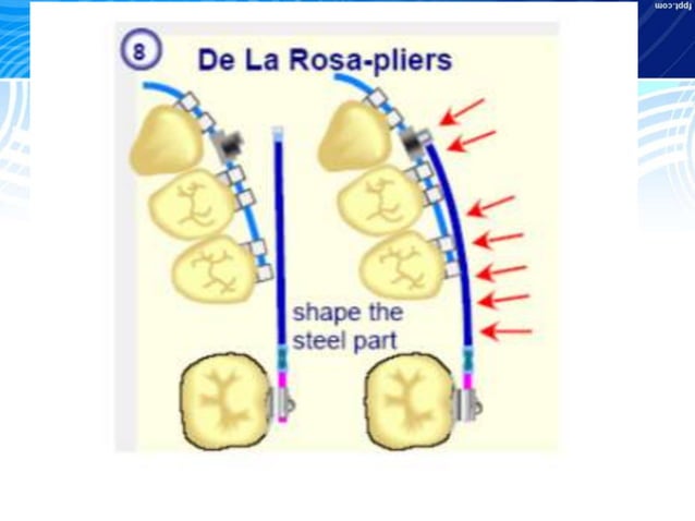 Memory Titanol Spring for Uprighting of Molar.pptx
