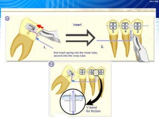 Memory Titanol Spring for Uprighting of Molar.pptx