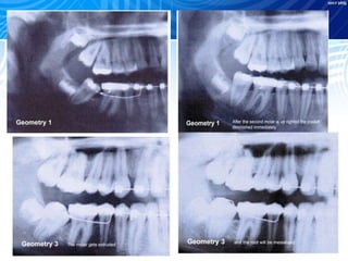 Memory Titanol Spring for Uprighting of Molar.pptx